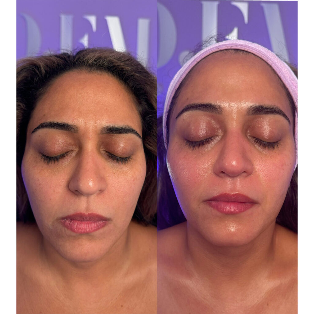 Anima Element Pro - DermaJEM