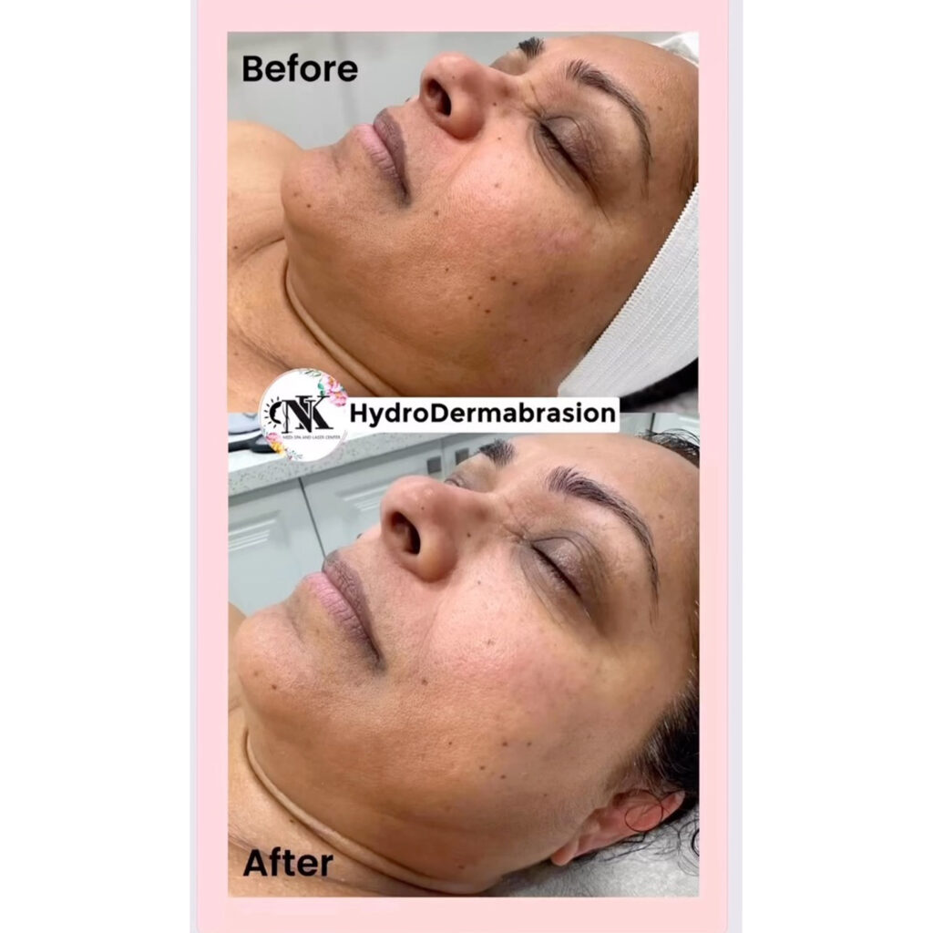 Anima Element Hydrodermabrasion/Oxygen Infusion | DermaJEM